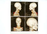 China High Density Medical X Ray Film Blue For Konida Laser Printer for sale