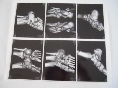 China Medical Dry Imaging Film For X Ray Examination On AGFA 5300, 5302, 5500 for sale