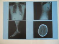 China KND-A Low Fog Medical Dry Imaging Film For X Ray Examination On AGFA 5300 / 5302 / 5500 for sale