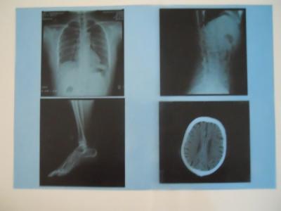 China KND-A Low Fog Medical Dry Imaging Film For X Ray Examination On AGFA 5300 / 5302 / 5500 for sale