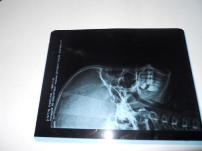 China KND-A Environment friendly Medical Dry Imaging Film For X Ray Examination On AGFA 5300 for sale