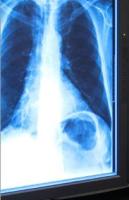 China Blue X-ray Dry Medical Imaging Film 11in x 17in For Thermal Printer for sale