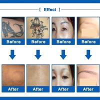 China Q Switched Nd Yag Laser Tattoo Removal Machine Freckle Removal 110V / 220V for sale