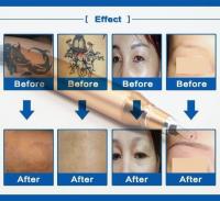 China OEM Q Switch Commercial Tattoo Removal Machine White Color ND Yag Laser for sale