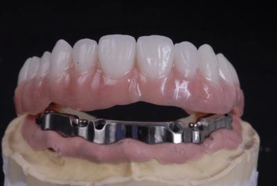 China Long-lasting Full Metal-Ceramic Restoration with Natural Tooth Appearance Fully Customizable for Crowns and Bridges for sale