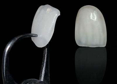 China Emax Veneer Dental Veneer with Flexural Strength up to ~600MPa Seamlessly Blends with Natural Teeth and Mimics Natural Color for sale