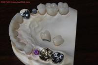 China Porcelain Dental Crown Tooth-Shaped Cap for Restoring Shape and Enhancing Appearance for sale
