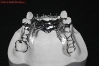 China Titanium Alloy Metal Framework for Removable Dentures - Lightweight and High Corrosion Resistance for sale