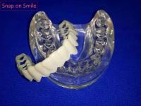 China Snap on Smile for sale