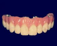 China Implant-Supported Bar Attachment in Titanium or Cobalt-Chromium Alloy for Even Force Distribution and Customizable Design for sale