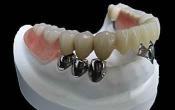 China Telescope crowns and denture for sale
