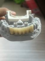 China CAD CAM milling technology enables zirconia dental restoration featuring natural tooth like appearance combined with high fracture toughness for sale