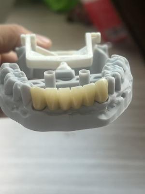 China CAD CAM milling technology enables zirconia dental restoration featuring natural tooth like appearance combined with high fracture toughness for sale