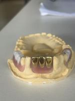 China Gold Material Dental Crown with Denture Attachment for Dental Restoration for sale