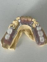 China Gold Material Dental Crown with Denture Attachment for Dental Restoration for sale
