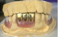 China Gold Material Dental Crown with Denture Attachment for Dental Restoration for sale