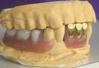 China Gold Material Dental Crown with Denture Attachment for Dental Restoration for sale
