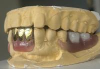 China Gold Material Dental Crown with Denture Attachment for Dental Restoration for sale