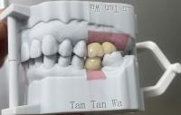 China Full Zirconia Screw Retained Abutment for Implant Supported Dental Restoration for sale