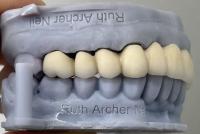 China Semi-precious Porcelain Fused to Metal Dental Bridge for Durable Dental Restoration for sale
