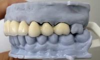 China Semi-precious Porcelain Fused to Metal Dental Bridge for Durable Dental Restoration for sale