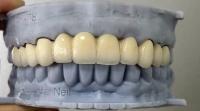 China Semi-precious Porcelain Fused to Metal Dental Bridge for Durable Dental Restoration for sale