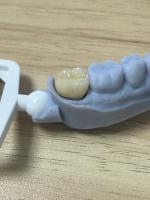 China Full Zirconia Dental Restorations High Strength • Natural Aesthetics • Long-Lasting Comfort for sale