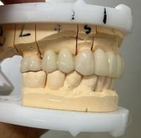 China Full Zirconia dental bridge for high strength and durable dental restoration for sale