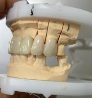 China Full Zirconia dental bridge for high strength and durable dental restoration for sale