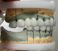 China Full Zirconia dental bridge for high strength and durable dental restoration for sale