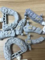 China Emax Inlay and Onlay Dental Restoration with Natural Teeth Color, Minimal Preparation, and High Translucency for sale