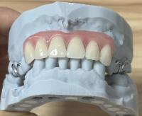 China Metal Framework with acrylic partial denture finish for sale