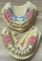 China Metal Framework with acrylic partial denture finish for sale