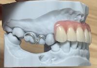 China Metal Framework with acrylic partial denture finish for sale