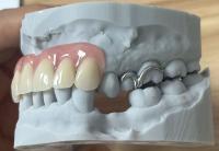 China Metal Framework with acrylic partial denture finish for sale