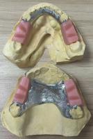 China Metal Framework with acrylic partial denture finish for sale