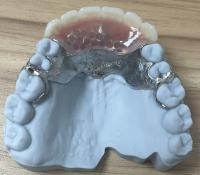China Metal Framework with acrylic partial denture finish for sale