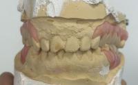 China Removable Denture with Lingual Bar Retention for High Precision Fit and Conservative Tooth Preservation for sale