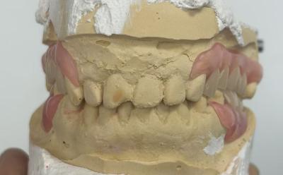 China Removable Denture with Lingual Bar Retention for High Precision Fit and Conservative Tooth Preservation for sale
