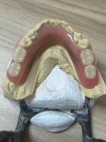 China Removable Denture with Lingual Bar Retention for High Precision Fit and Conservative Tooth Preservation for sale