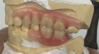 China Removable Denture with Lingual Bar Retention for High Precision Fit and Conservative Tooth Preservation for sale