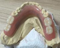 China Removable Denture with Lingual Bar Retention for High Precision Fit and Conservative Tooth Preservation for sale