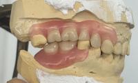 China Removable Denture with Lingual Bar Retention for High Precision Fit and Conservative Tooth Preservation for sale