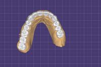 China Precision Fit Digital Wax Up Dental Study Model with Durable and Biocompatible 3D Printed Design for sale