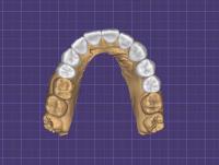 China Precision Fit Digital Wax Up Dental Study Model with Durable and Biocompatible 3D Printed Design for sale