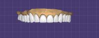 China Precision Fit Digital Wax Up Dental Study Model with Durable and Biocompatible 3D Printed Design for sale