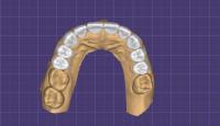 China Precision Fit Digital Wax Up Dental Study Model with Durable and Biocompatible 3D Printed Design for sale