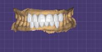 China Precision Fit Digital Wax Up Dental Study Model with Durable and Biocompatible 3D Printed Design for sale