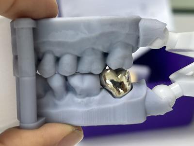 China Gold Crown Dental Crown with Gold Material, Durable and Aesthetic Finish for Restoration for sale
