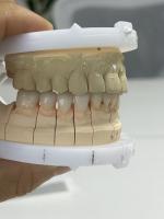 China Full Zirconia Dental Crown - Biocompatible High Strength Zirconia Dental Restoration for sale